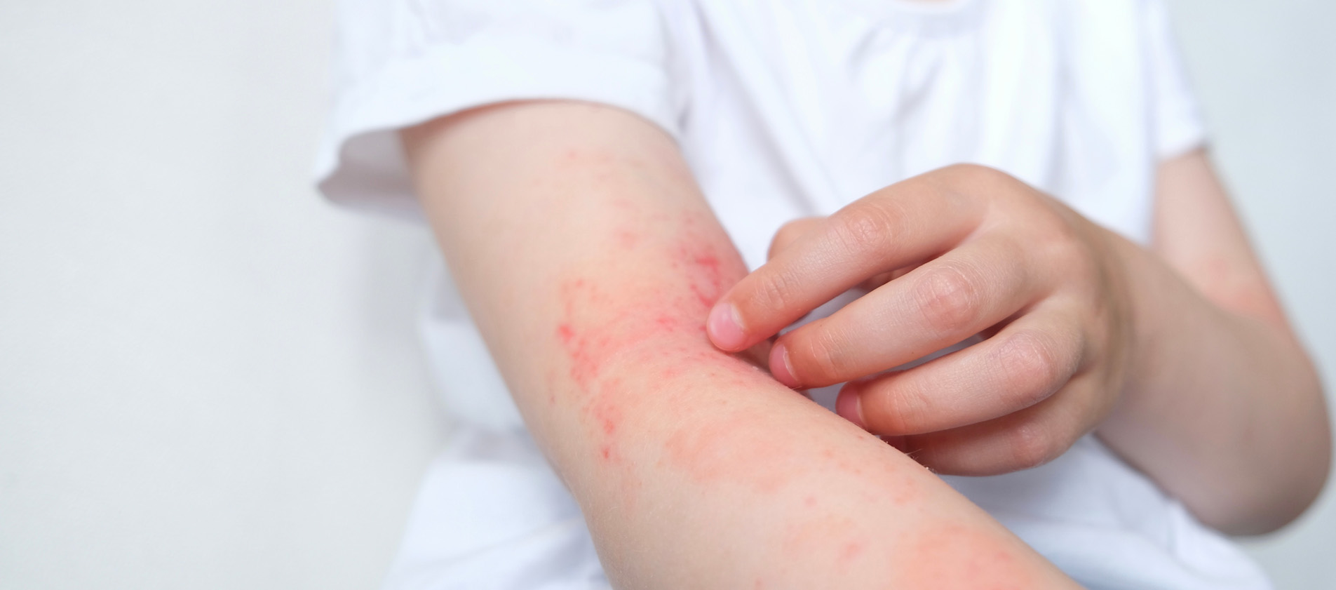 Understanding, Managing, and Treating Eczema - Oxona Health